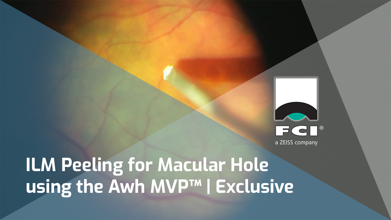 New Video | ILM Peeling for Macular Hole using the Awh MVP™ | Exclusive ...